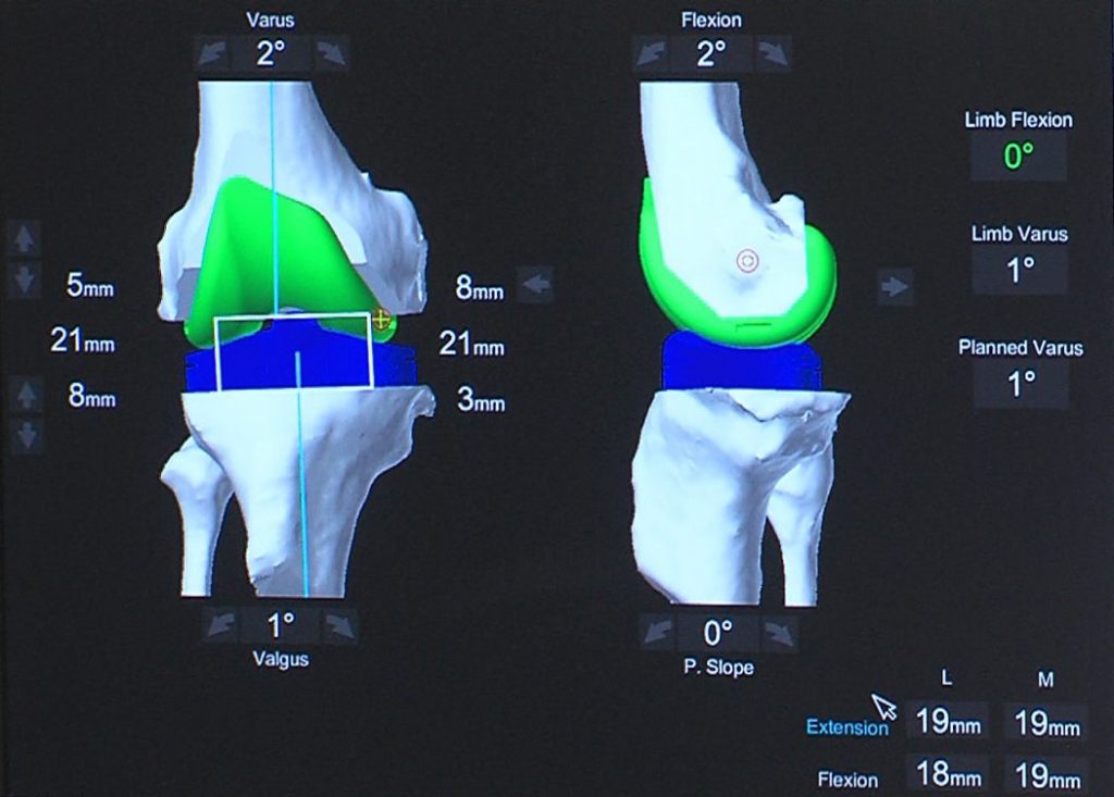 Mako, precisión humanoide en artroplastia de rodilla - EFE Salud
