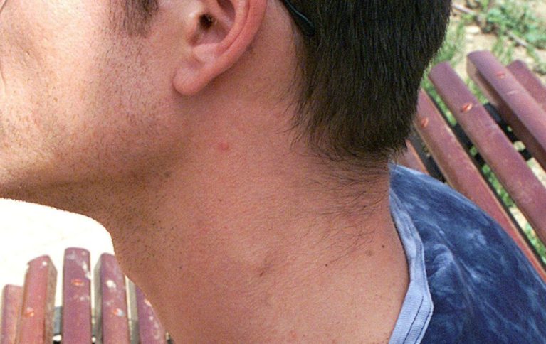 Ganglios linfáticos: ¿Qué es este bulto que tengo en el cuello?