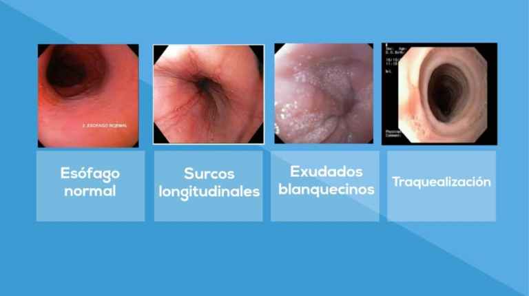 Esofagitis eosinofílica, cuando tragar puede resultar una pesadilla ...