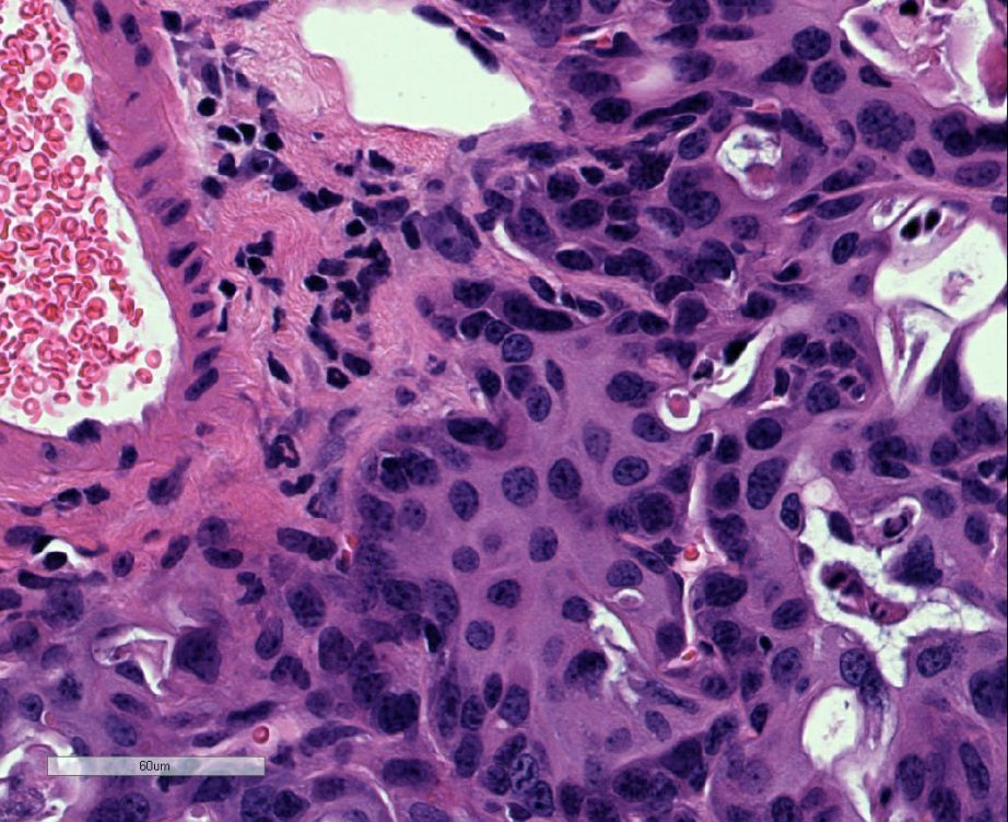 Artículo del doctor Rubén Pío sobre cáncer de pulmón