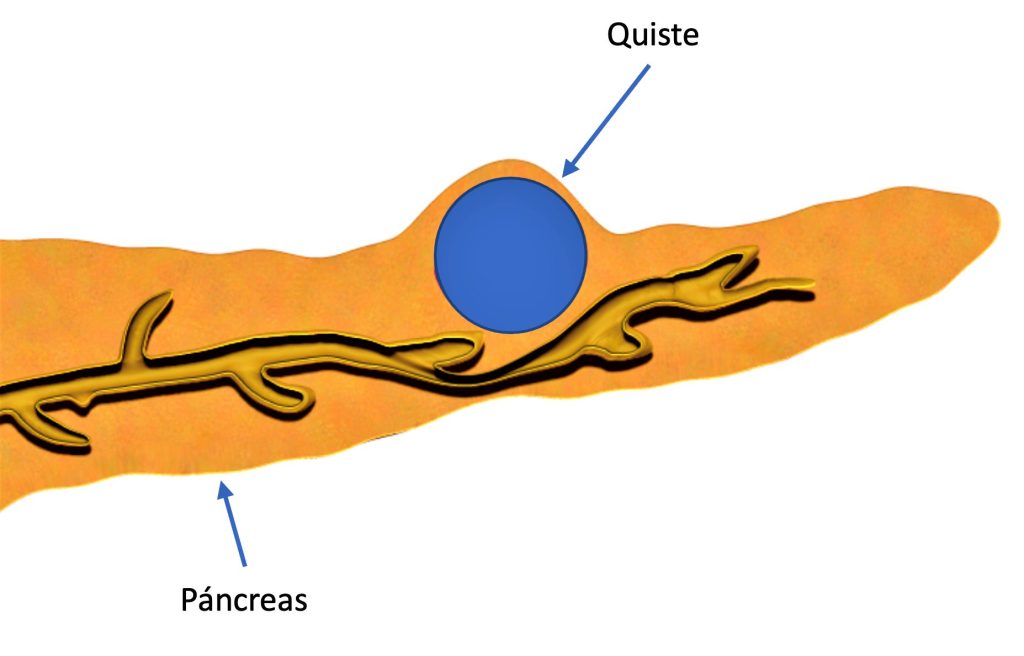 Las enfermedades del páncreas, un órgano huraño