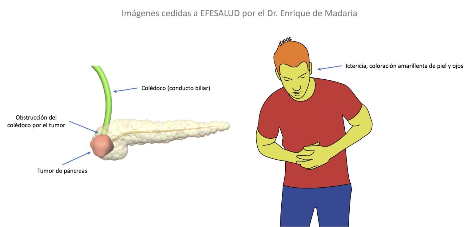 Las enfermedades del páncreas, un órgano huraño