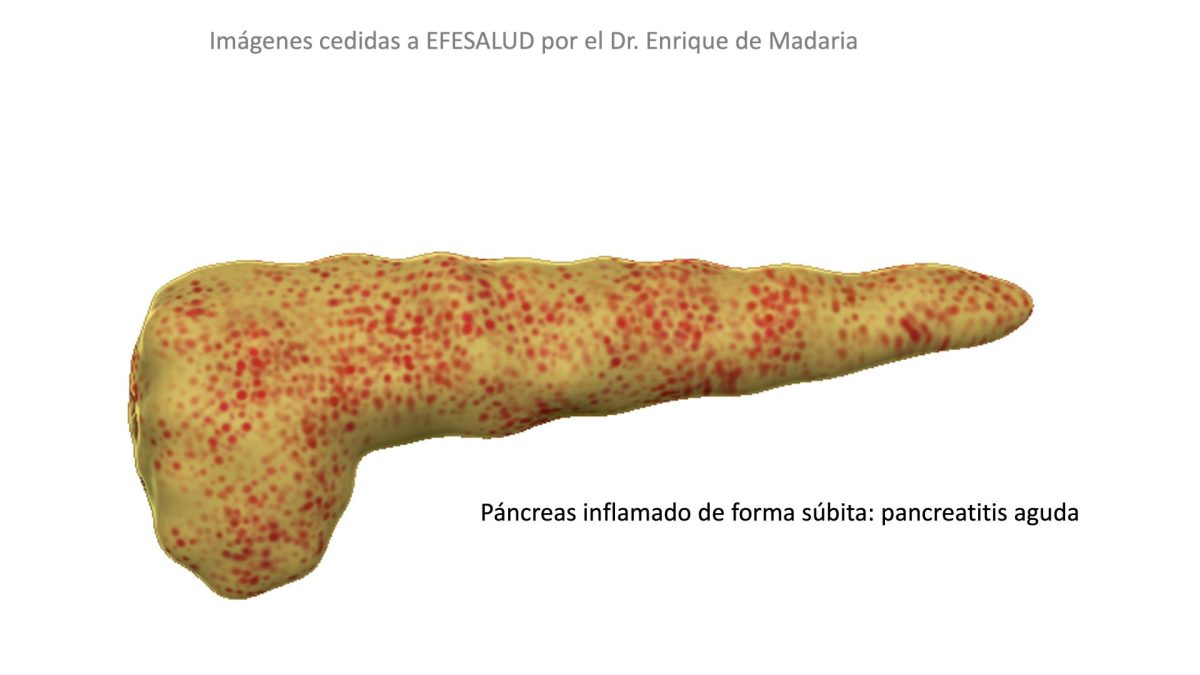 Las enfermedades del páncreas, un órgano huraño
