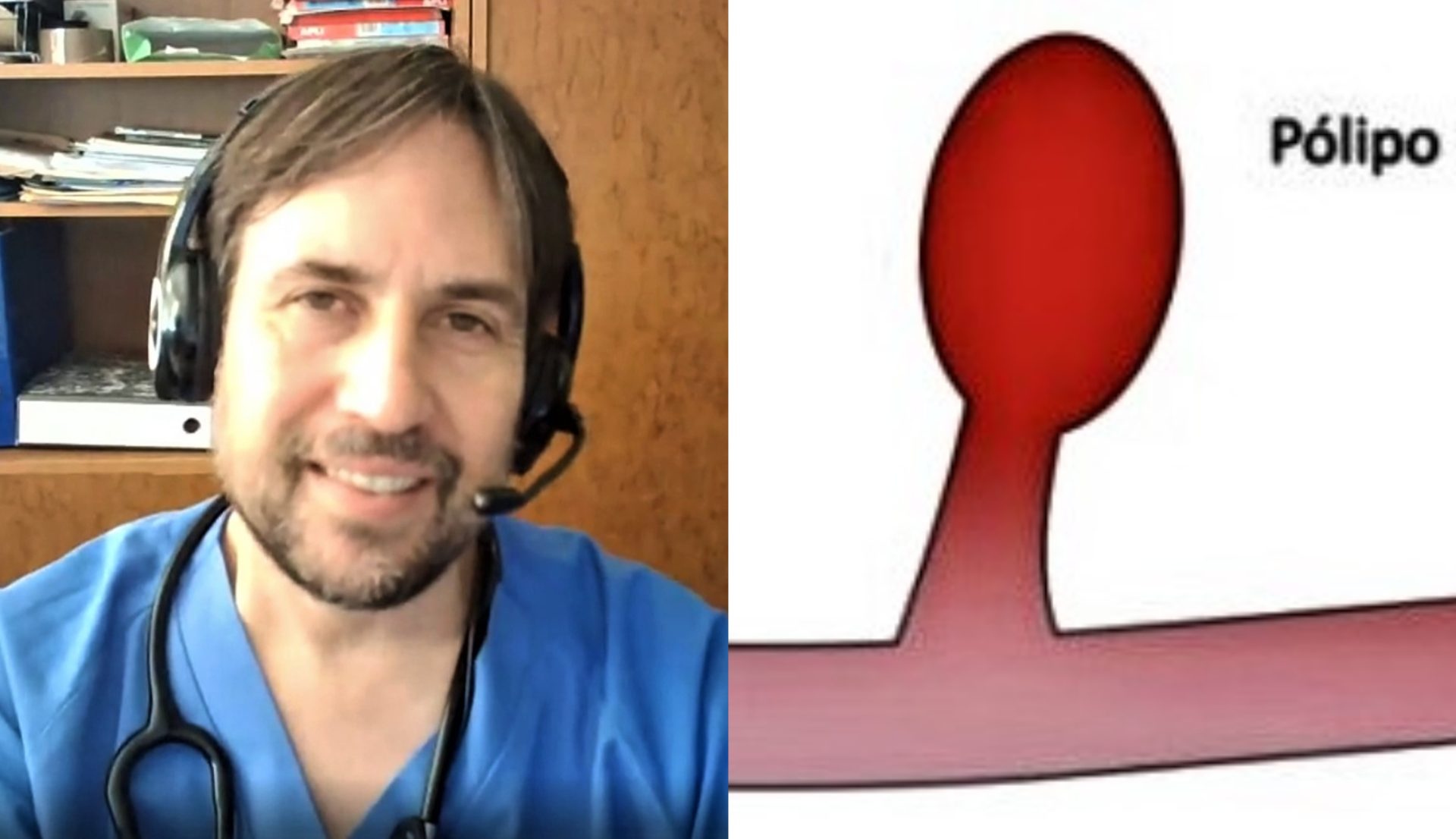 De pólipos buenos a pólipos malos, el cáncer de colon