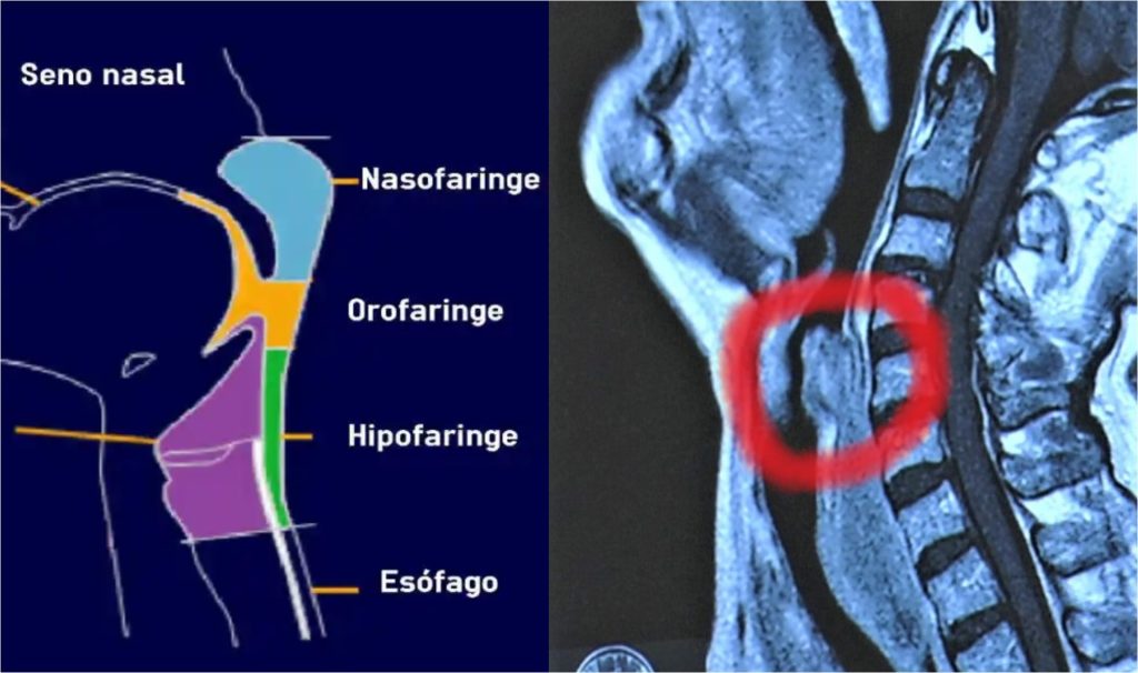 La conmoción de la garganta por el virus del papiloma