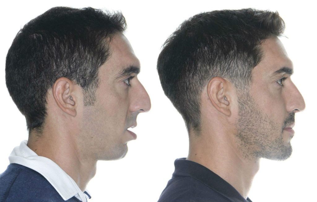 Cirugía ortofacial: modificar la estructura ósea facial