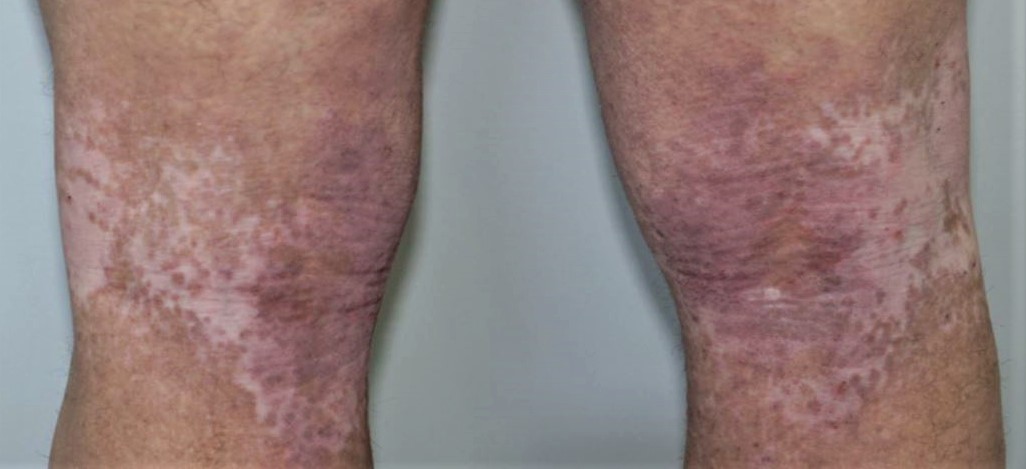 Dermatitis atópica, ¡Vamos a por ella! - EFE Salud