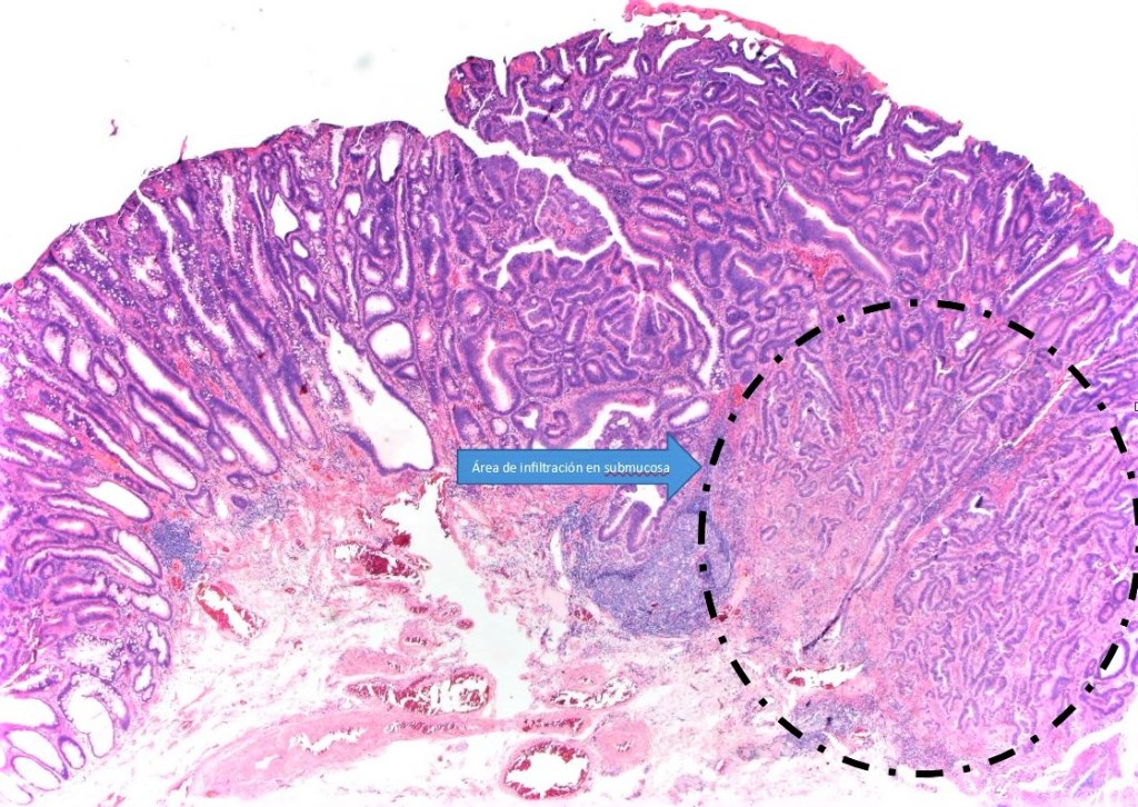 Colonoscopia digital para fichar pólipos malignos