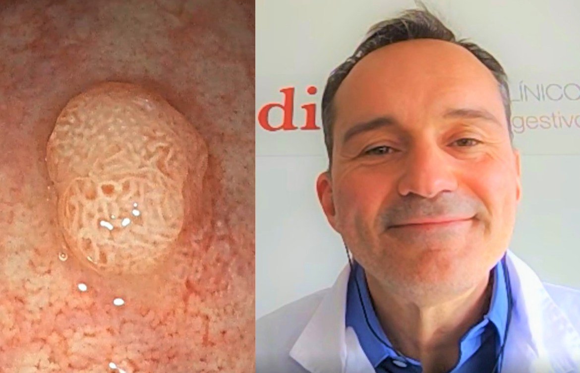 Colonoscopia digital para fichar pólipos malignos