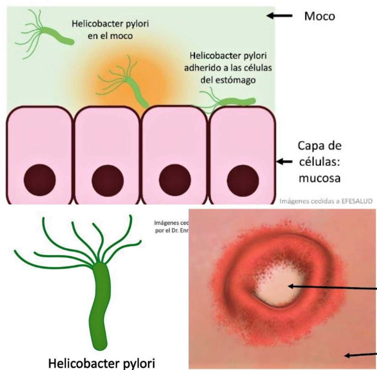 Lesiones precursoras del cáncer de estómago
