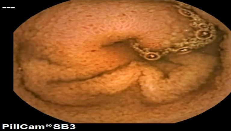 Viaje endoscópico al tubo digestivo: yeyuno, íleon y colon