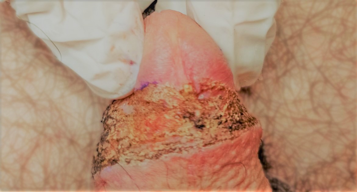 ¿Qué es la balanitis o la balanopostitis?