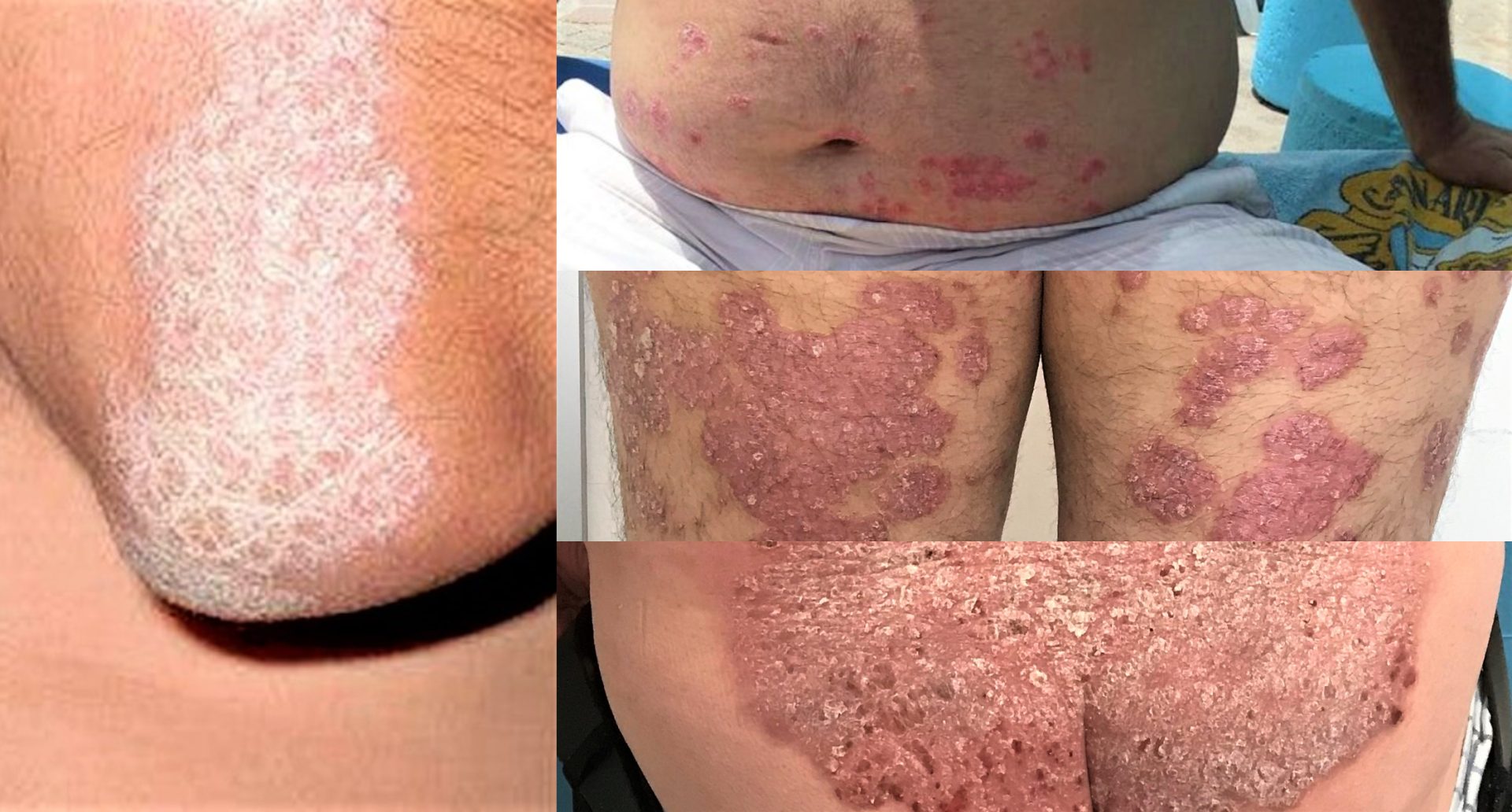 Psoriasis: signos y síntomas en la lupa dermatológica